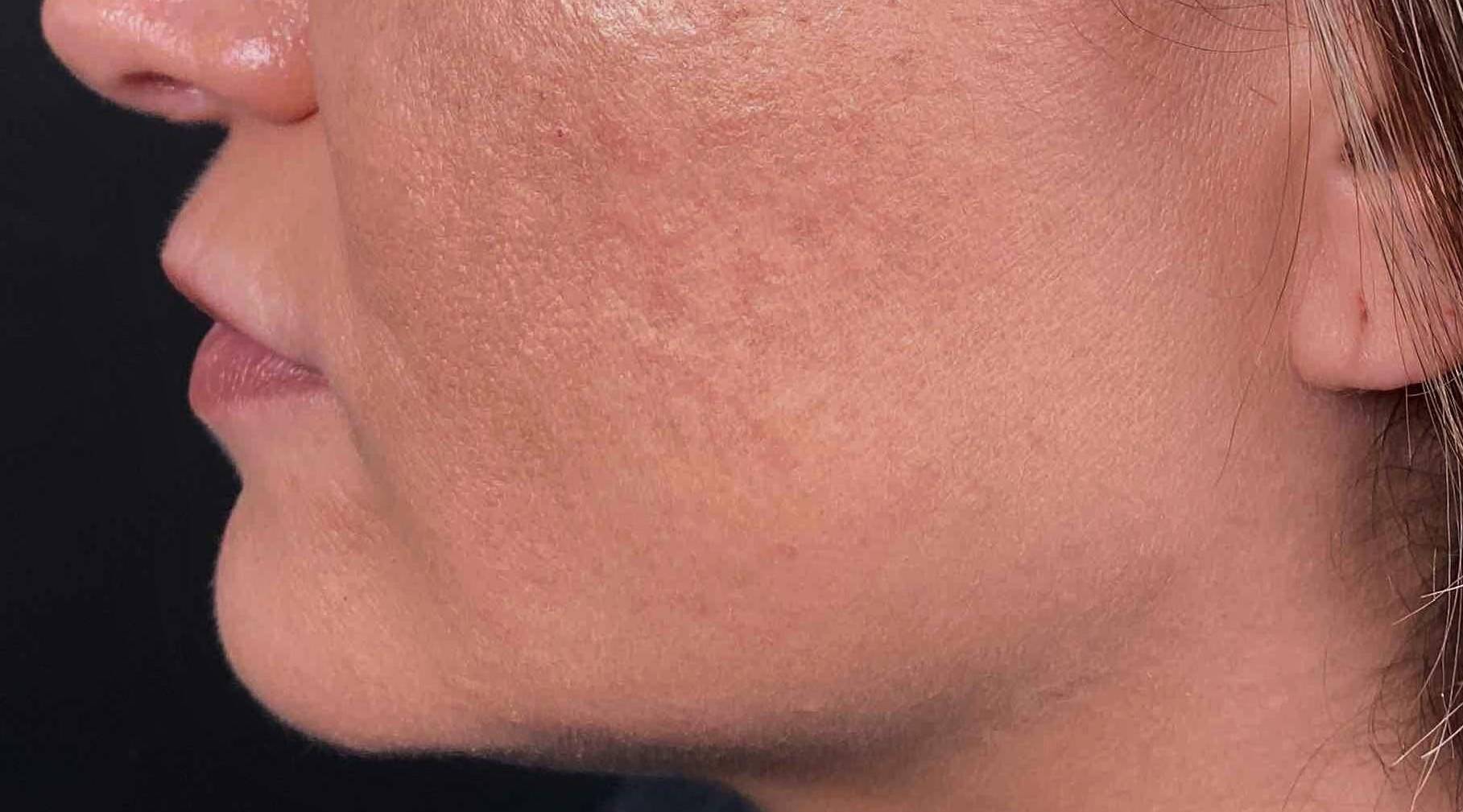 Procedures - Photo Gallery | Dermatologist Dr. Ellen Turner | Dallas Area
