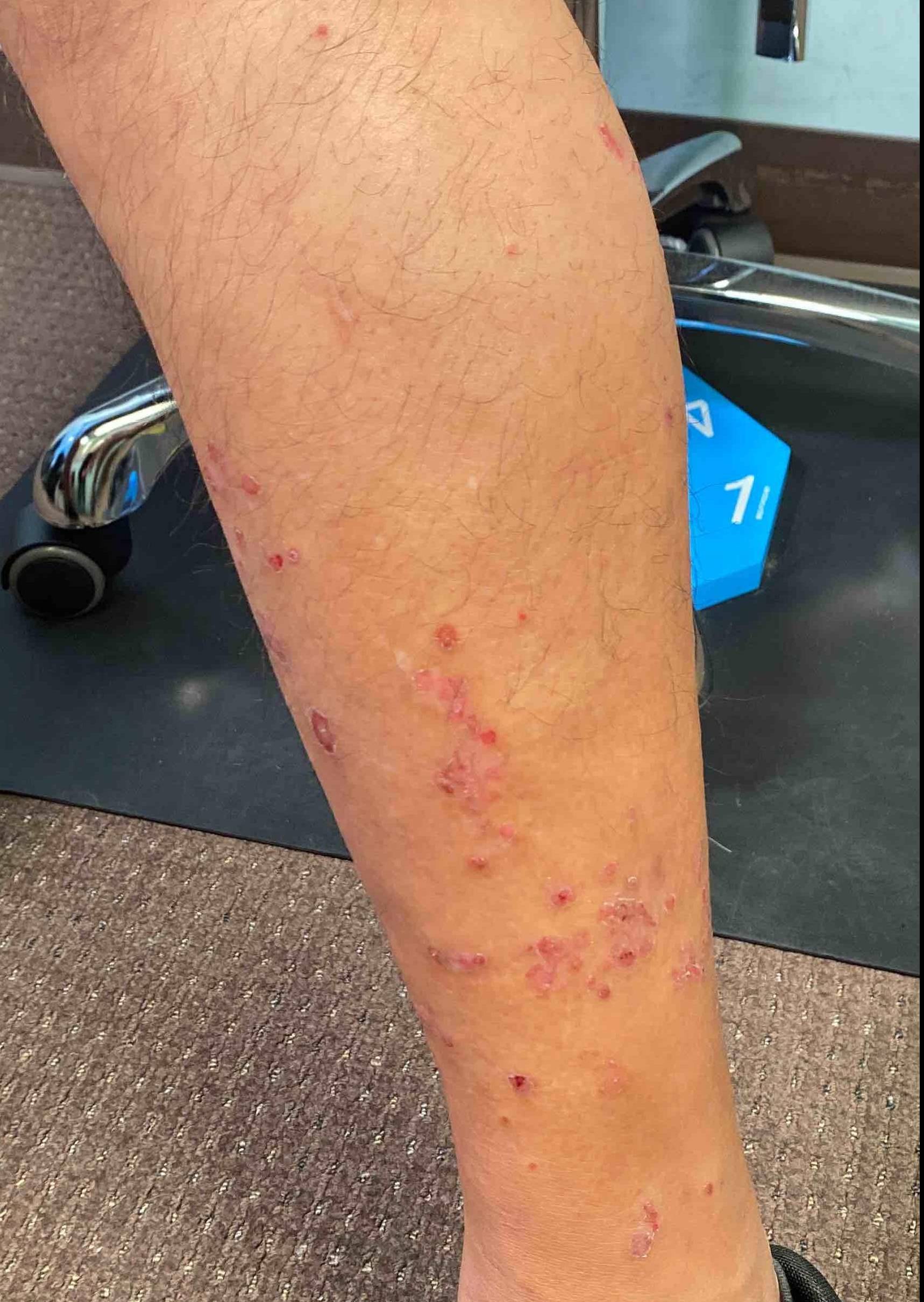 Psoriasis Legs Treatment