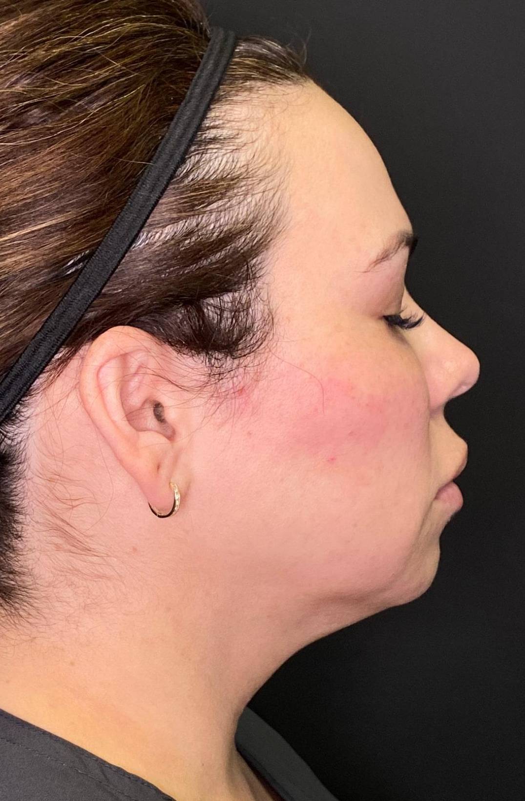 Procedures - Photo Gallery | Dermatologist Dr. Ellen Turner | Dallas Area