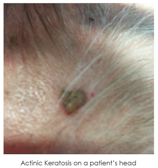 Actinic Keratosis Dallas Texas Dr Ellen Turner