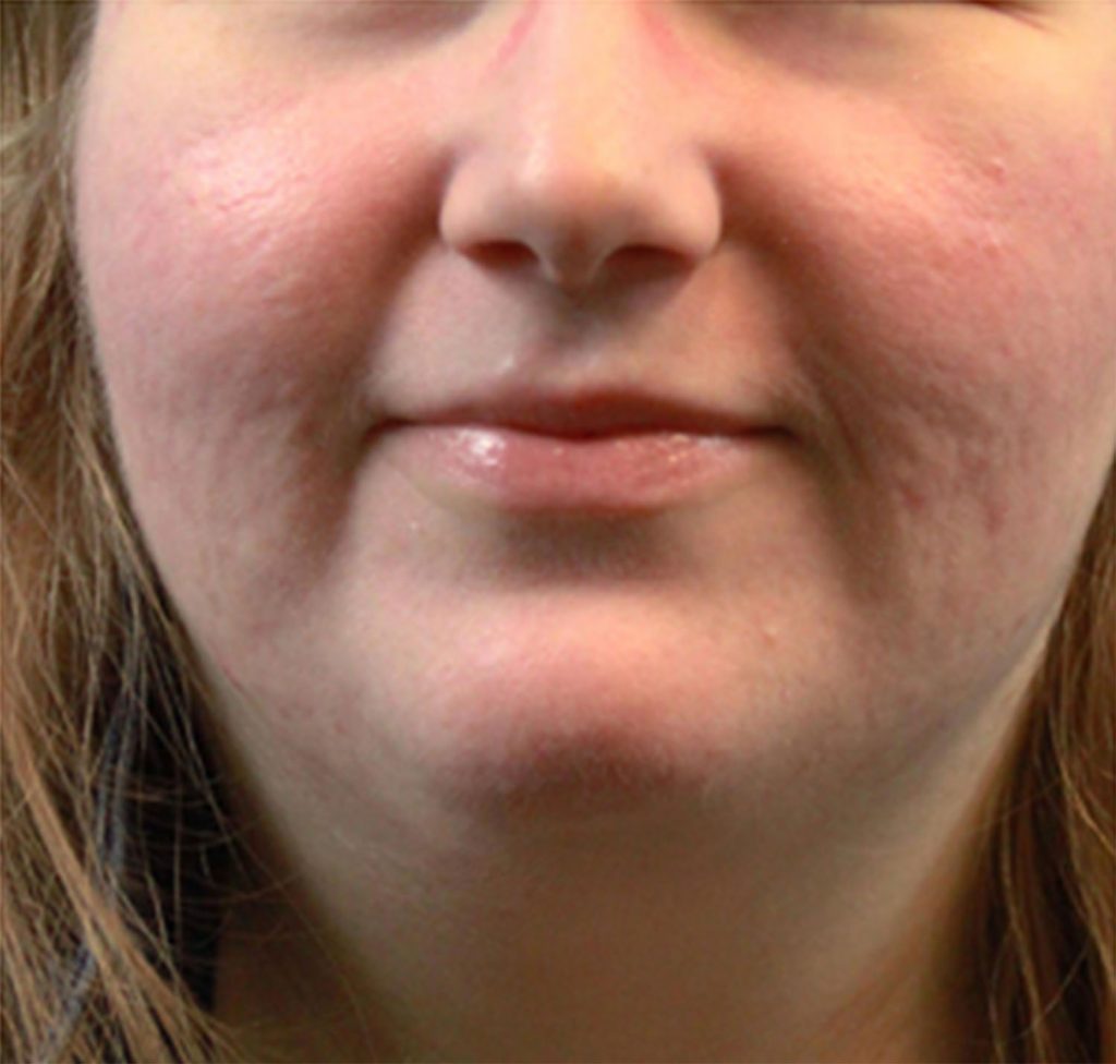 Acne treatment in the Dallas area | Dr. Ellen Turner