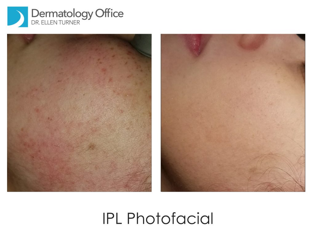 IPL (Intense Pulsed Light) | Dr. Ellen Turner | Dallas Area