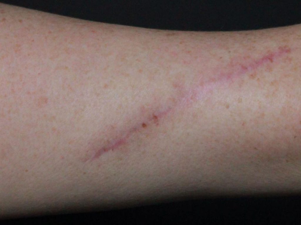 Microneedling | Dr. Ellen Turner | Dallas Area