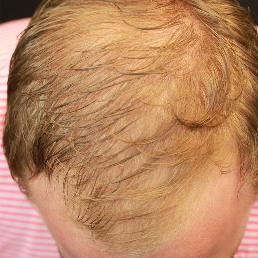 Nonsurgical Hair Restoration | Dallas, Texas | Dr. Ellen Turner