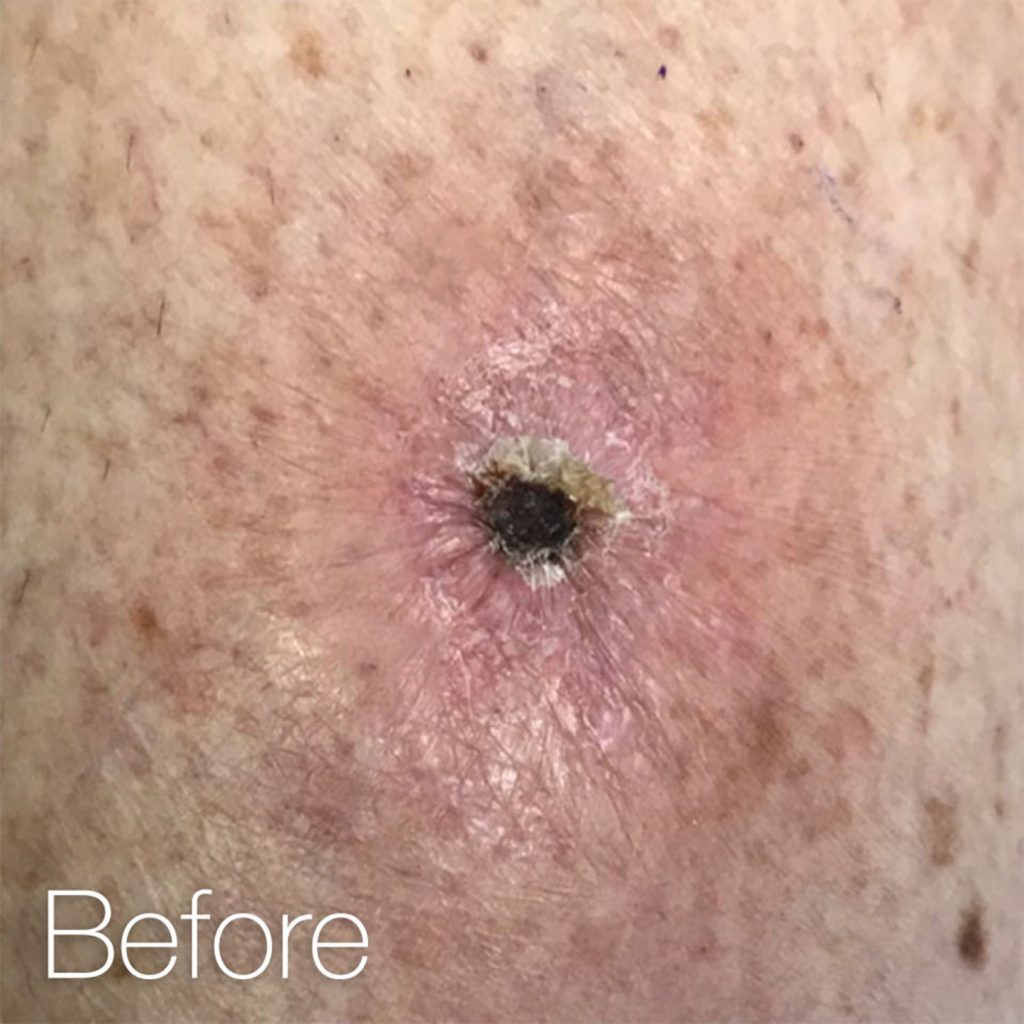 Skin Cancer | Dallas | Dr. Ellen Turner