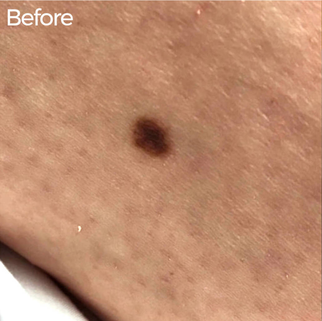 Moles and Treatment in the Dallas Area | Dr. Ellen Turner