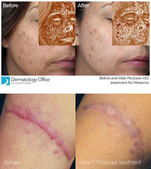 Treatment for Hyperpigmentation| Dallas, TX | Dr. Ellen Turner