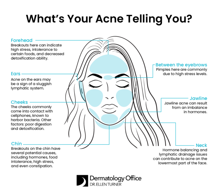 Acne treatment in the Dallas area | Dr. Ellen Turner