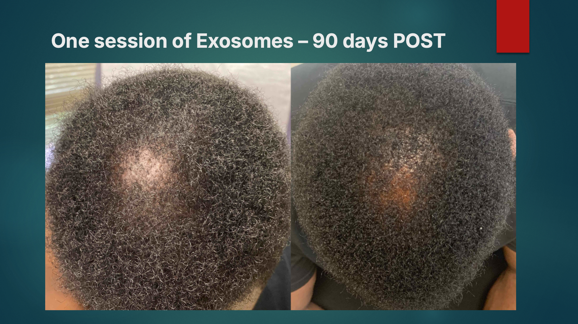 Exosomes: The New PRP (Platelet-Rich Plasma) - Dermatologist Dallas TX ...