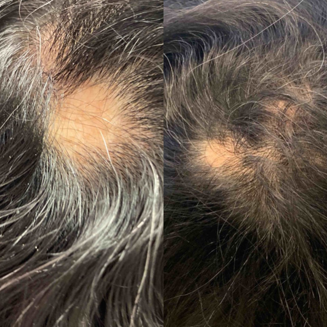 Exosomes: The New PRP (Platelet-Rich Plasma) - Dermatologist Dallas TX ...