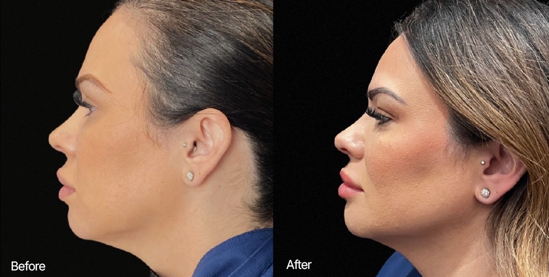 The Snatch & Lift - Dermatologist Dallas TX | Dermatology Irving | Dr ...