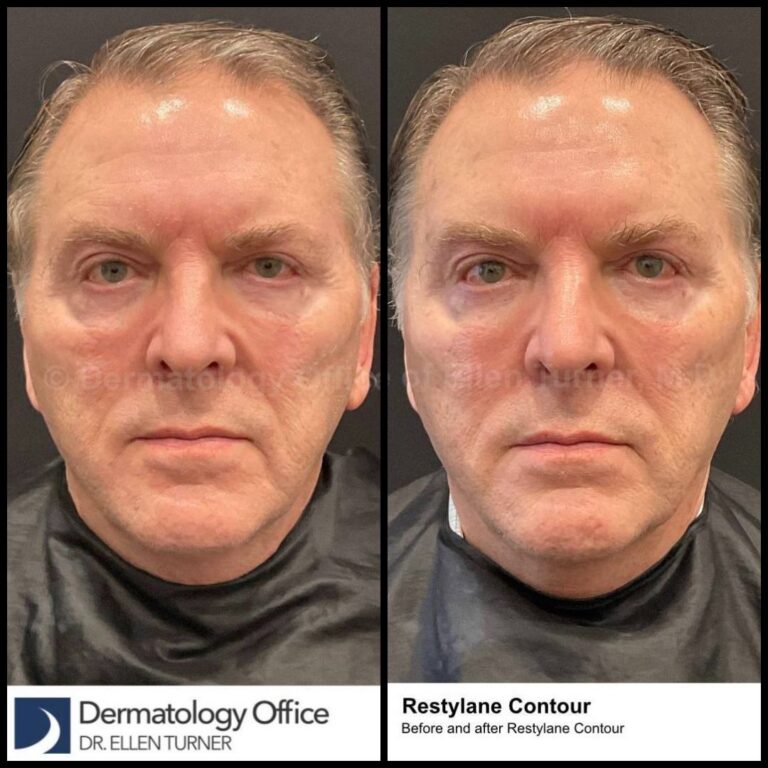 Restylane Refyne | Dallas, Irving | Dermatology Office